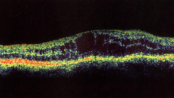 Cystoid Macular Edema | South Bay Ophthalmology