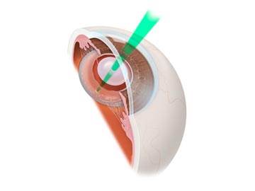 Posterior Laser Capsulotomy | South Bay Ophthalmology