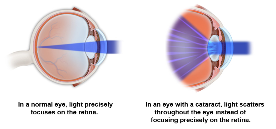 Cataracts | South Bay Ophthalmology