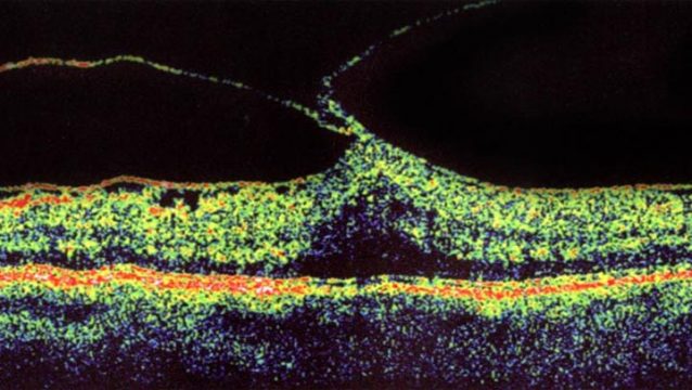 Macular Pucker | South Bay Ophthalmology