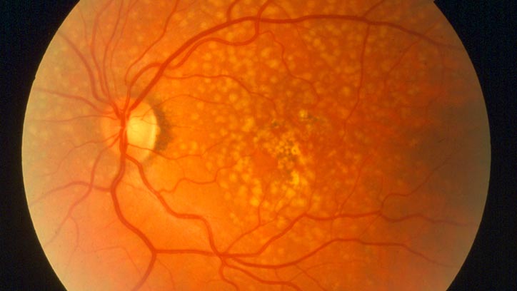 Macular Degeneration | South Bay Ophthalmology
